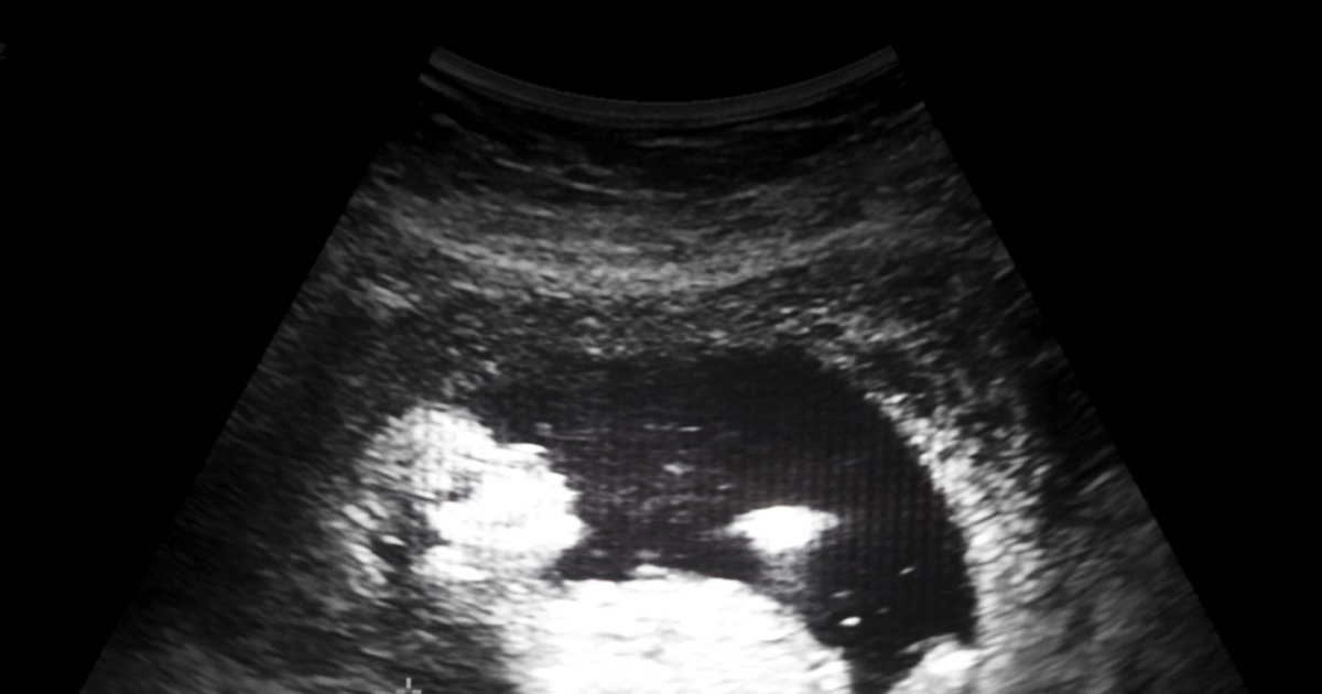 Trump Administration Reviewing Contracts With Fetal-Tissue Providers | NTD