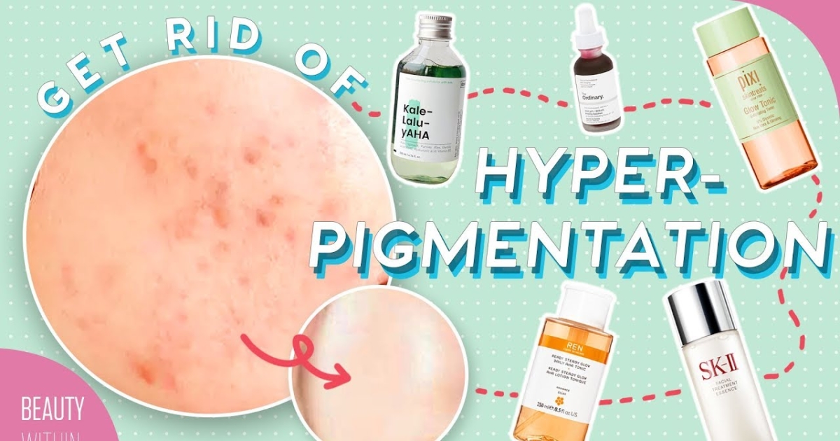 Best Ways to Reduce Hyperpigmentation and Dark Spots: Ingredients ...
