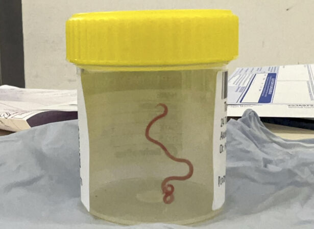 Neurosurgeon Investigating Patient's Mystery Symptoms Plucks a Worm ...